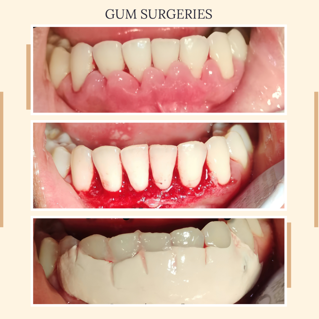 Gum Surgery/pyorrhoea – CITYDENT Dental & Implant Clinic